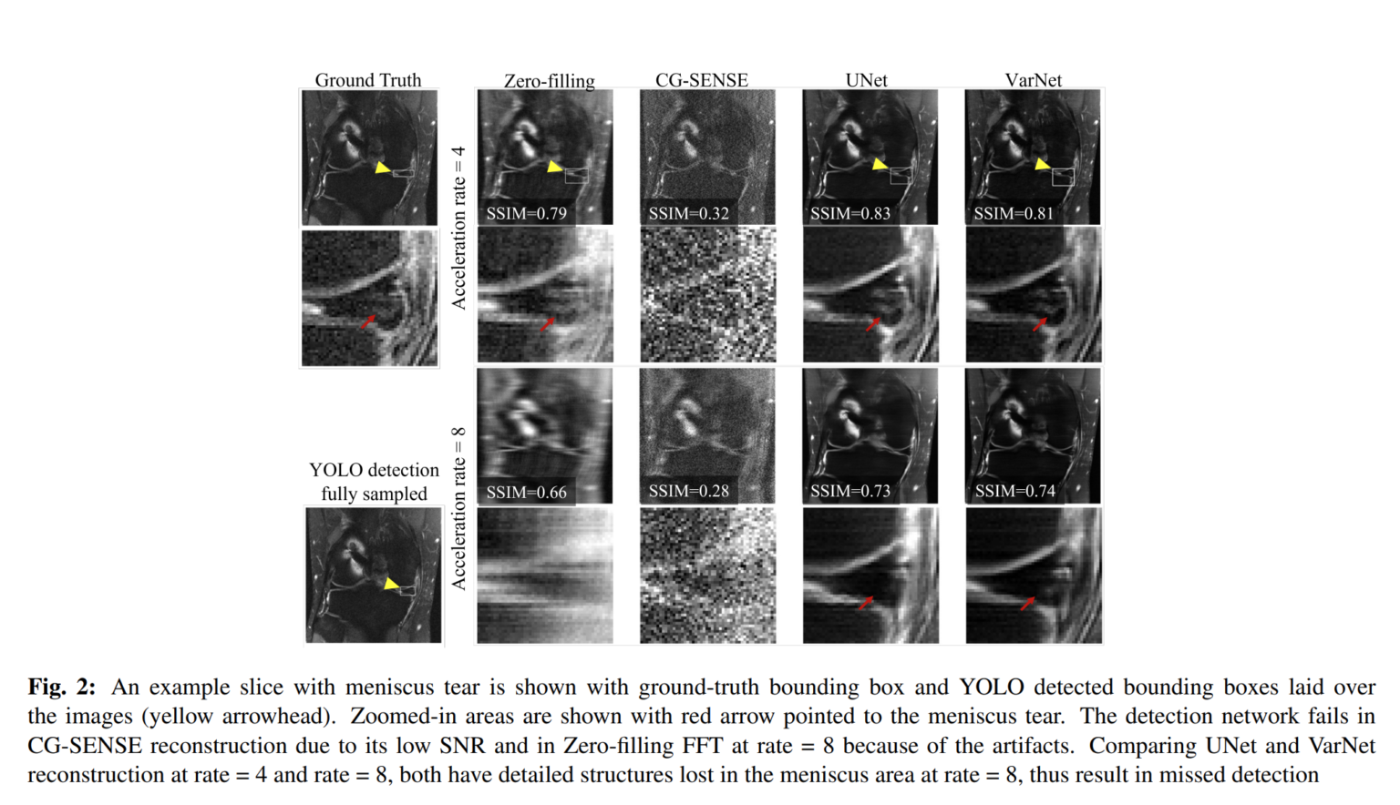 End-to-End AI-based MRI Reconstruction and Lesion Detection Pipeline ...