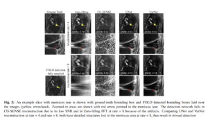End-to-End AI-based MRI Reconstruction and Lesion Detection Pipeline ...