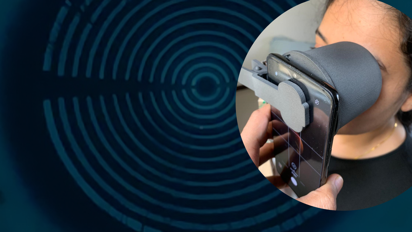 SmartKC: A Smartphone-based Corneal Topographer - Microsoft Research