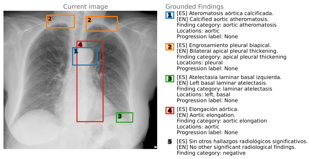 PadChest-GR: A bilingual grounded radiology reporting benchmark for ...
